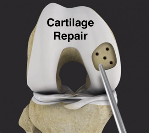 Cartilage Repair Ayazlakdawala