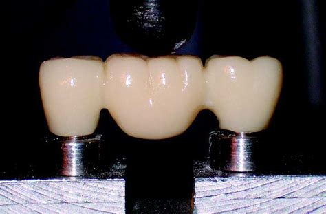 Three Unit All Ceramic Fixed Partial Denture Download Scientific Diagram