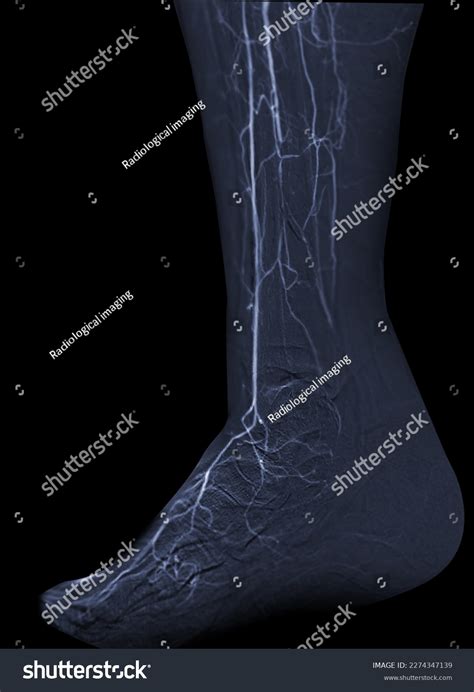 Femoral Artery Angiogram Angiography Lower Extremity Stock Illustration 2274347139 Shutterstock