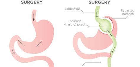 Gastric Bypass Surgery Can It Work For You What Does It Cost