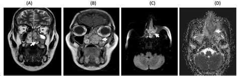 Pathologically Proven Recurrent Spindle Cell Sarcoma Of The Left Download Scientific Diagram