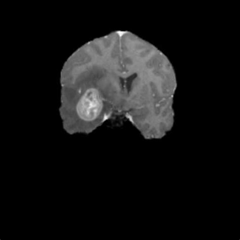 Mmenendezg Brain Tumor Object Detection · Datasets At Hugging Face