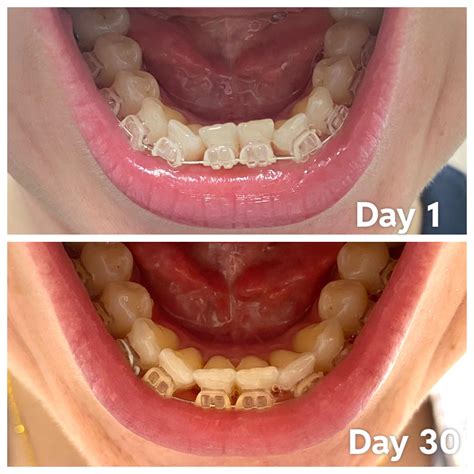 4 Week Progress R Braces