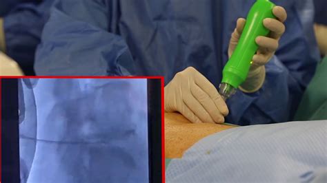 Diskom™ Percutaneous Discectomy Probe Live Surgery With Dr Cecchetti Youtube