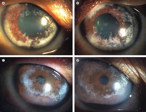 Corneal Snowflakes The Lancet