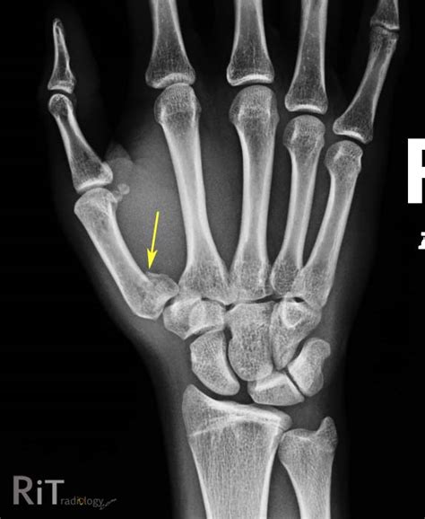 Rit Radiology Bennetts Fracture Dislocation