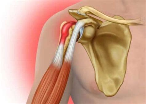 Biceps Tenodesis Shoulder Surgeon Austin Round Rock Cedar Park Tx