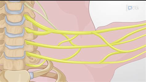 Vidéo Exposition Du Plexus Brachial Une Technique Chirurgicale Pour