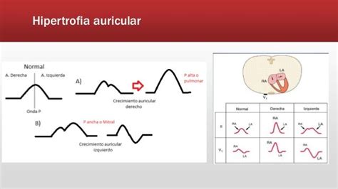 Electrocardiograma Hipertrofia