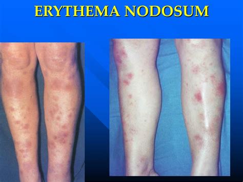 Ppt Dermatological Manifestations Of Systemic Disease Powerpoint