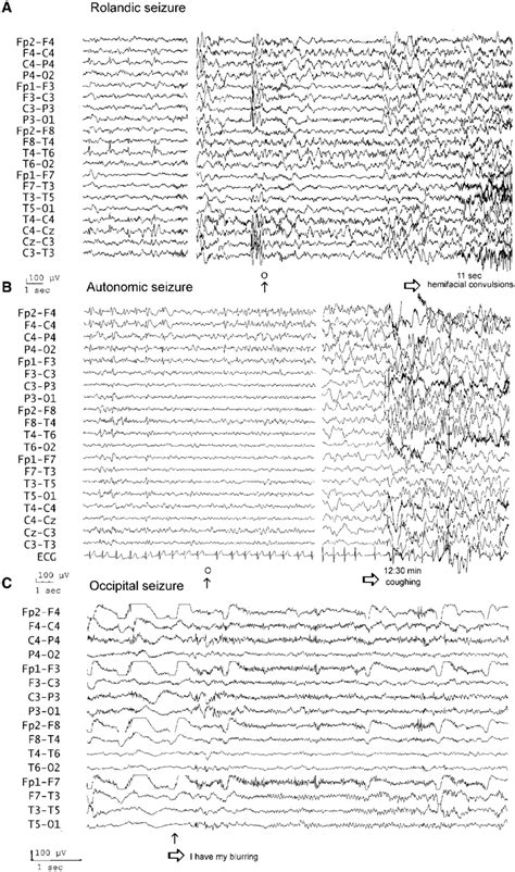 Ictal Eeg Of Rolandic A Autonomic B And Occipital Lobe C