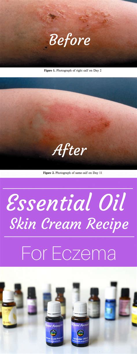 Facial Oil For Eczema At Raven Goetz Blog