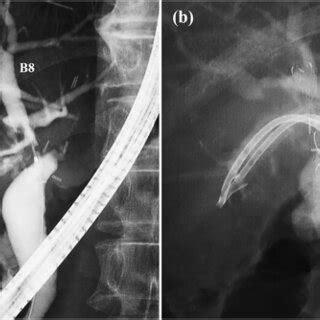 This Patient Was A 73yearold Male With An Anastomotic Biliary Download Scientific Diagram