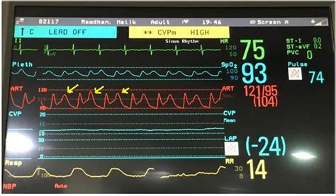 Abnormal Arterial Waveforms