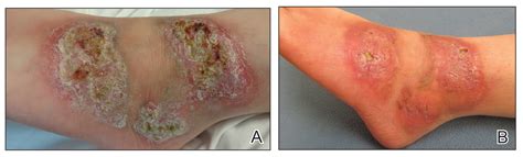 Pyoderma Vegetans
