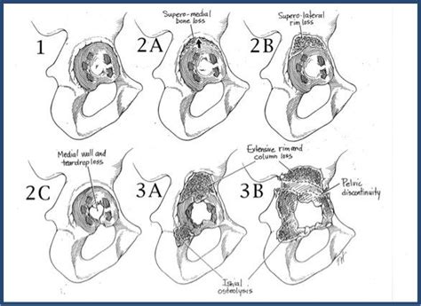 Aaos Classification Of Acetabular Defects Pdf Aaos Classification Of Acetabular Defects Pdf