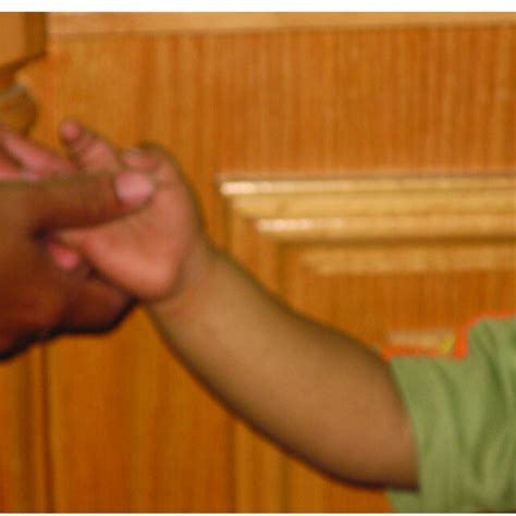 Hyperpigmentation Of The Foot Before Treatment Download Scientific Diagram