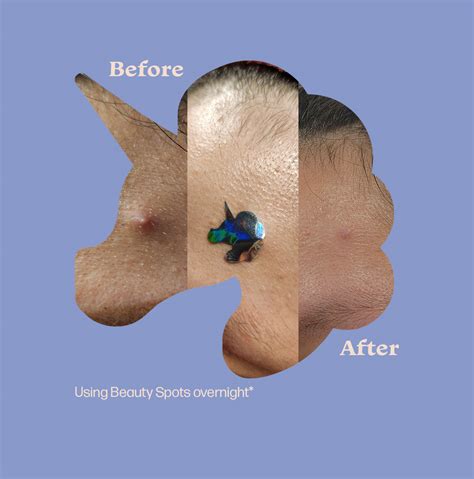 Beauty Spots Pimple Patches Urban Jungle