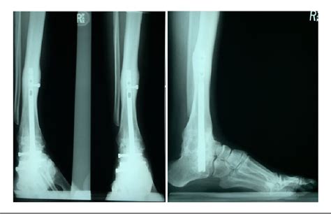Figure 1 From Tibiotalocalcaneal Arthrodesis Nails Semantic Scholar