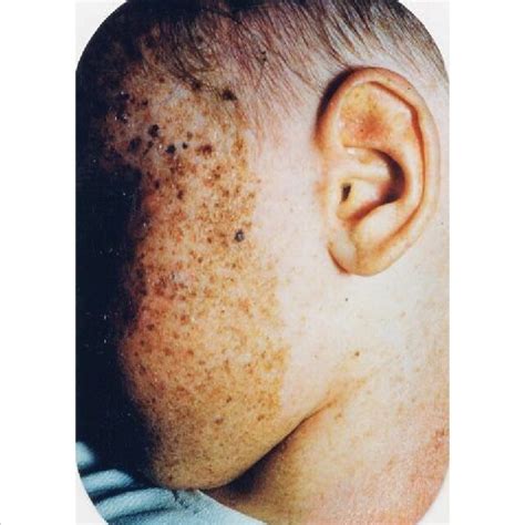 A 10 Year Old Female With Mottled Hypopigmentation Involving The