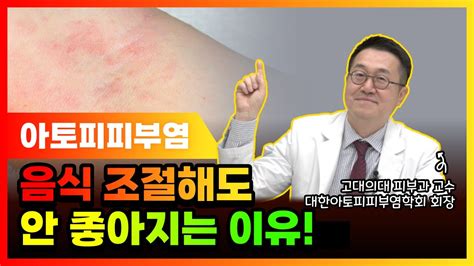먹고 싶은 건 참지 말고 아토피 피부염 치료해요 고대병원 피부과 교수 Youtube