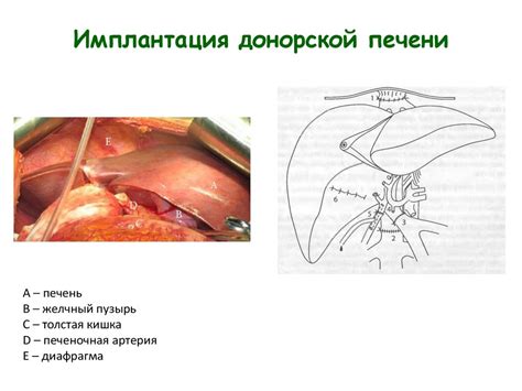 Трансплантация печени Послеоперационные осложнения Клинический случай презентация онлайн
