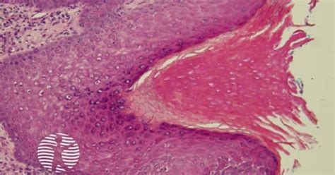 White Circles On Dermatoscopy Of Scc Image