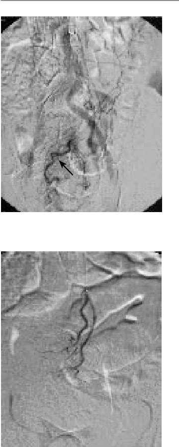 Figure 1 From Management Of Ischemic Proctitis With Severe Rectal