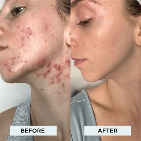 Pimples On Face Before And After