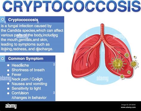 Informative Poster Of Cryptococcosis Illustration Stock Vector Image And Art Alamy