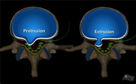 The Radiology Assistant Lumbar Disc Nomenclature 20