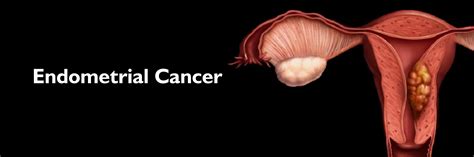 Endometrial Cancer Causes Symptoms Diagnosis And Treatment