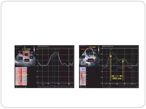 Speckle Tracking Echocardiography Pptx