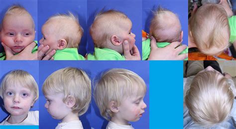 Craniofacial Anomalies Facial Plastic Surgery Clinics