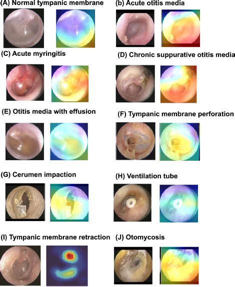 Tympanic Membrane Perforation Icd 9 Code