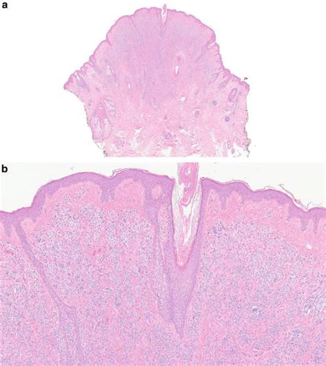 Acquired Melanocytic Nevus Basicmedical Key