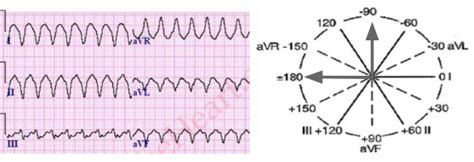 Axis Deviation Quiz