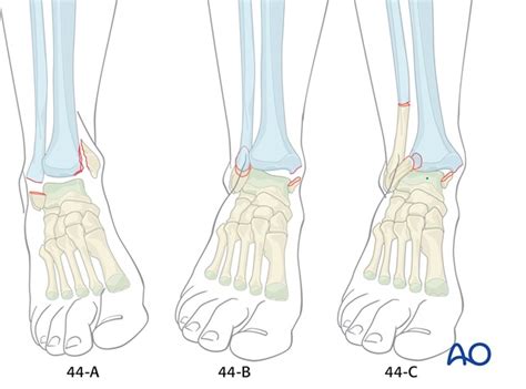 Tibia Ankle Fracture