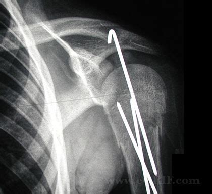 Pediatric Proximal Humerus Fracture