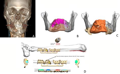 Matrix Mandible Surgical Technique At Mary Tylor Blog
