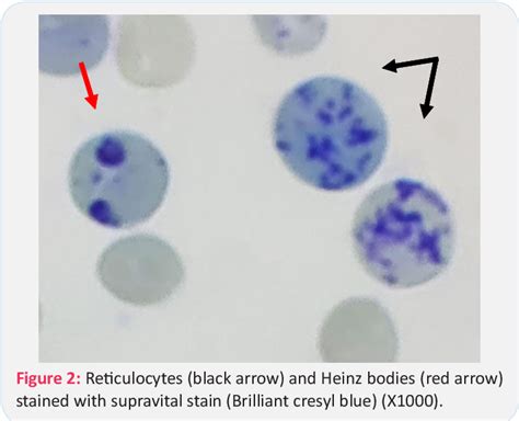 Figure 2 From Reticulocyte Indexes And Their Significance Semantic