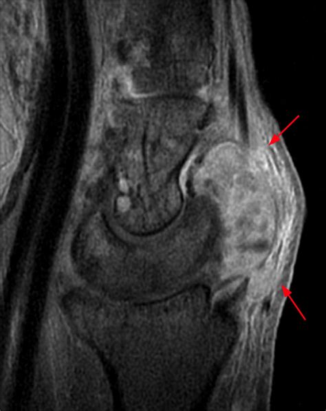 Calcium Pyrophosphate Dihydrate Cppd Crystal Deposition Disease Radsource