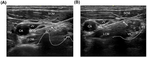 Novel Ultrasound Guided Cervical Sympathetic Chain Pulsed Radiofrequen