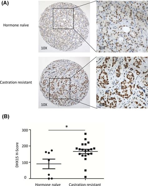 Dhx15 Is Up Regulated In Castration Resistant Prostate Cancer And