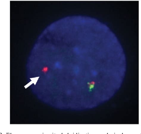 Figure 1 From Rapidly Progressive Primitive Neuroectodermal Tumor Of The Prostate A Case Report
