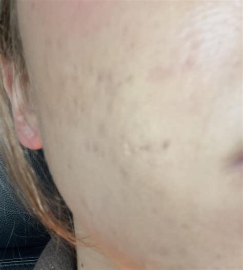 Acne Scars Racne
