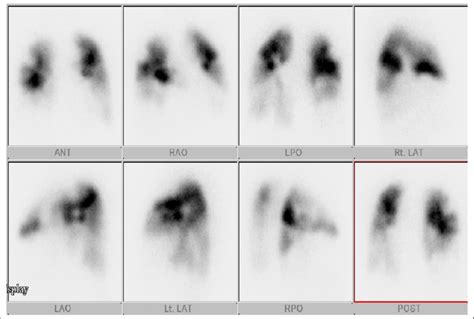 Lung Perfusion Scan Shows Moderate Photon Defect In Both Lower Lobes Download Scientific Diagram