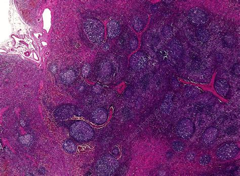 Haemorrhagic Lymph Nodes Light Micrograph Stock Image C0508402