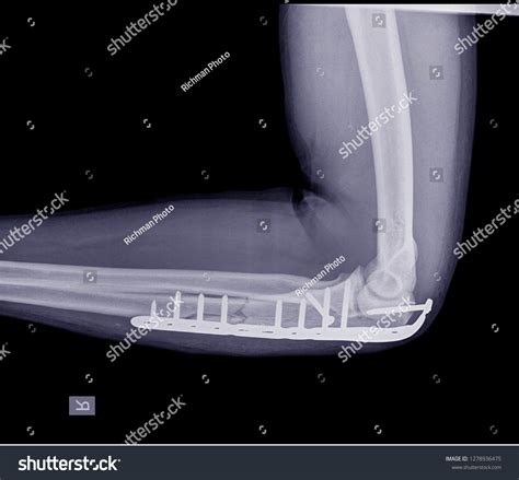 Olecranon Process Of Ulna Over 121 Royalty Free Licensable Stock Photos Shutterstock