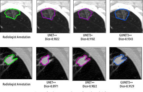 Figure 5 From An Enhanced Unet Variant For Effective Lung Cancer